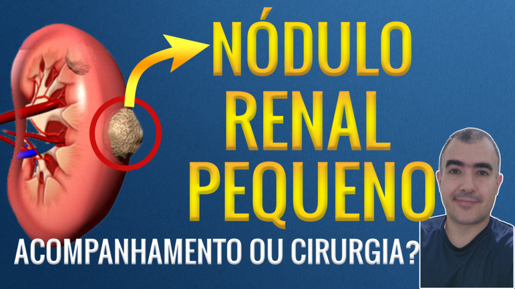 Nódulo no rim pequeno: Acompanhamento ou Cirurgia? - Dr. Lucas Felipe ...